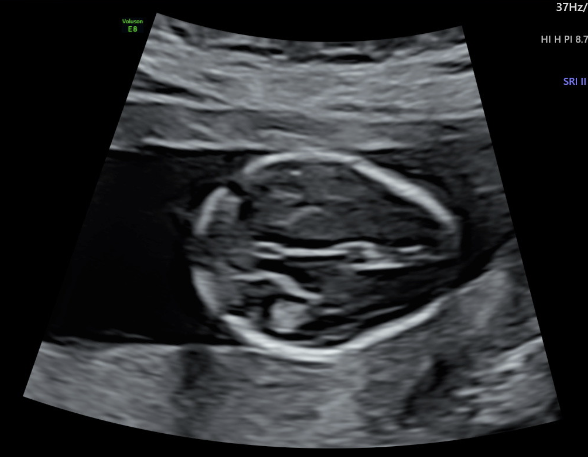 Nuchal Translucency Scans/ Early Anatomy Scans — Trinity Imaging
